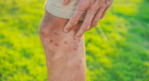 Bed Bug Bites Guide: Dermatologist Misdiagnosing